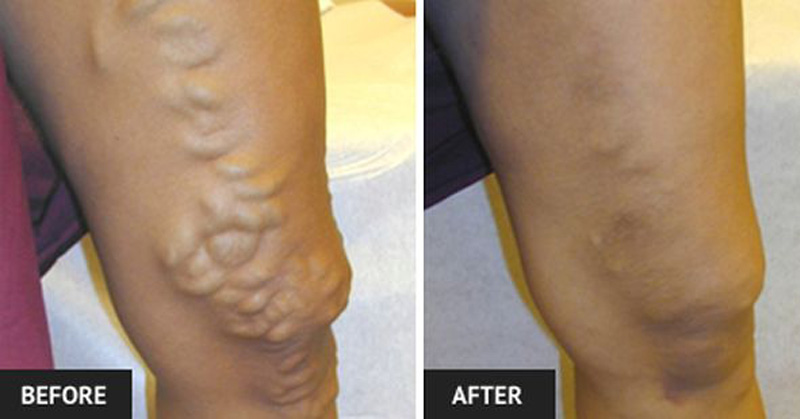 9 Remedies That Treat Varicose Veins Without Surgery! - DavidWolfe.com